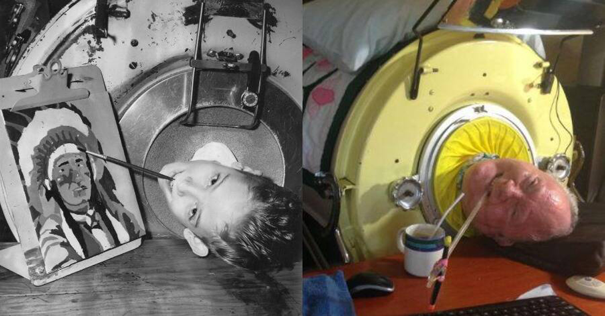 76-Year-Old Polio Survivor, Paralyzed at 6, Among the Final Few to Use ...