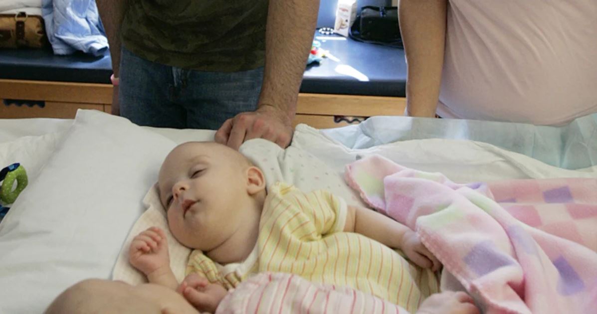 Surgical Intervention Altered the Physical Bond of Conjoined Twins ...